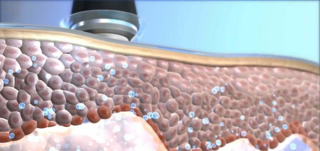 RF Beauty Device With Ultrasonic Function | Reversepcb